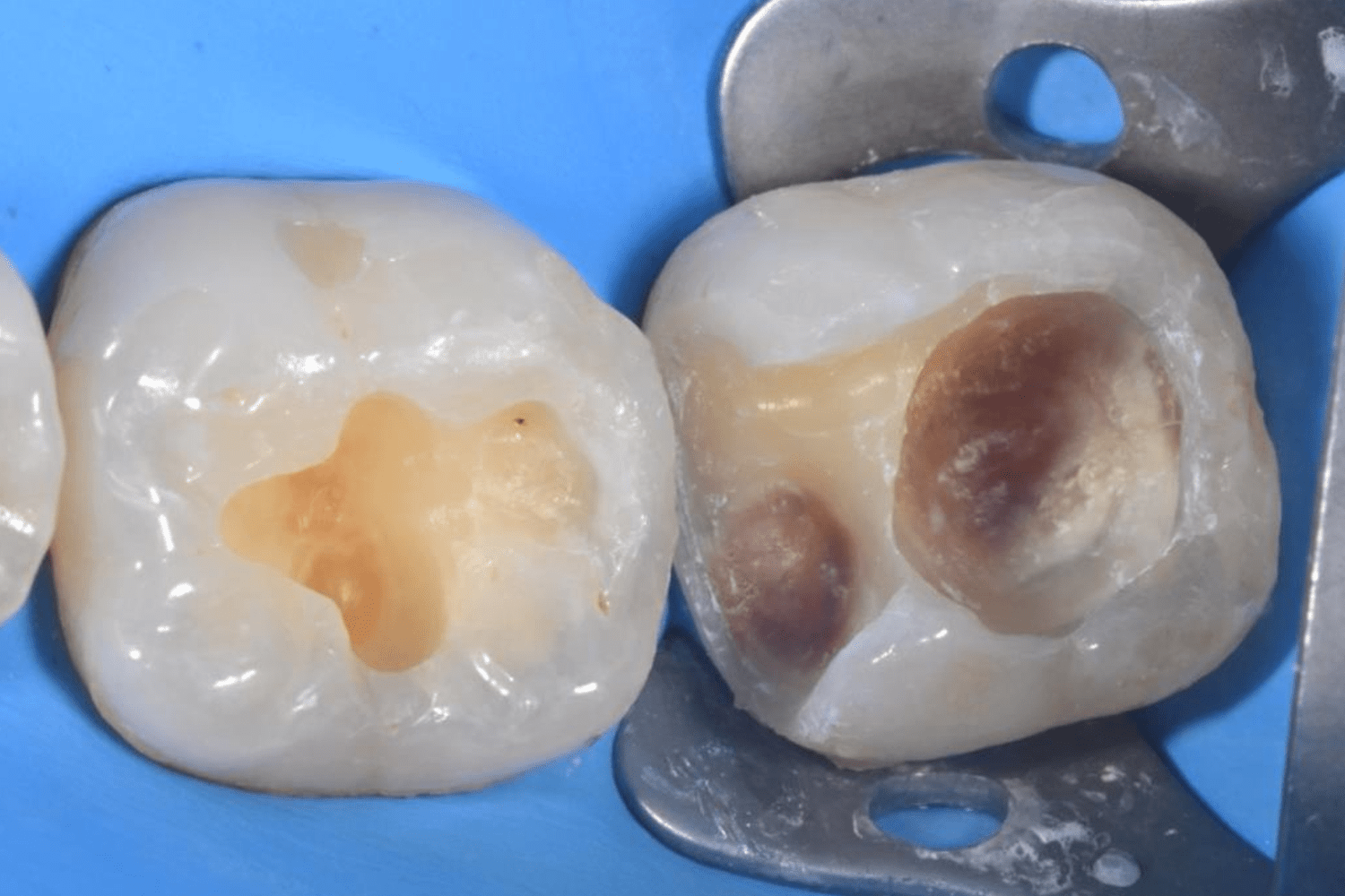 Indirekte Pulpaüberkappung: Bio-Bulk Fill-Verfahren und Bulk&Go